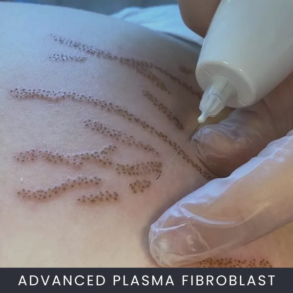 Advanced Plasma Fibroblast Course Online – The Online Beauty Courses US