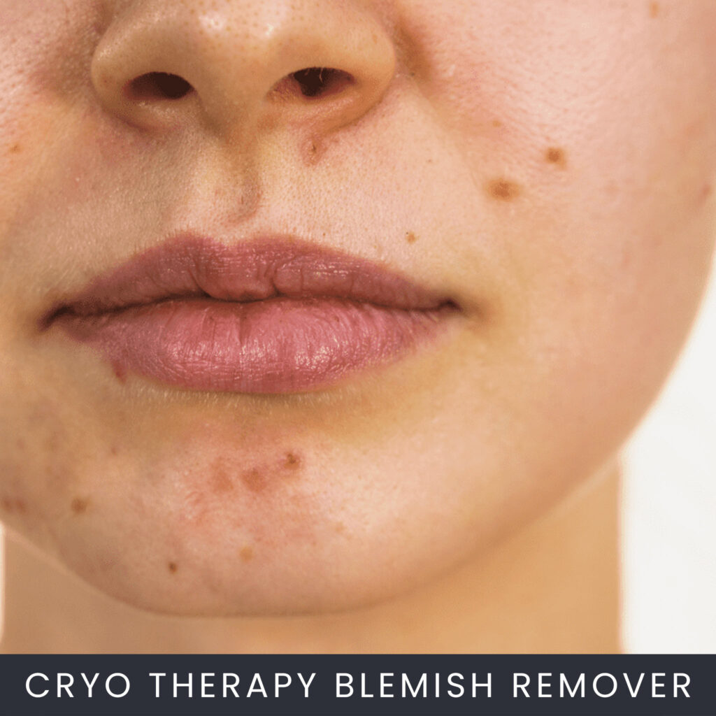 Cryo Therapy Blemish Removal Course Online - The Online Beauty Courses US