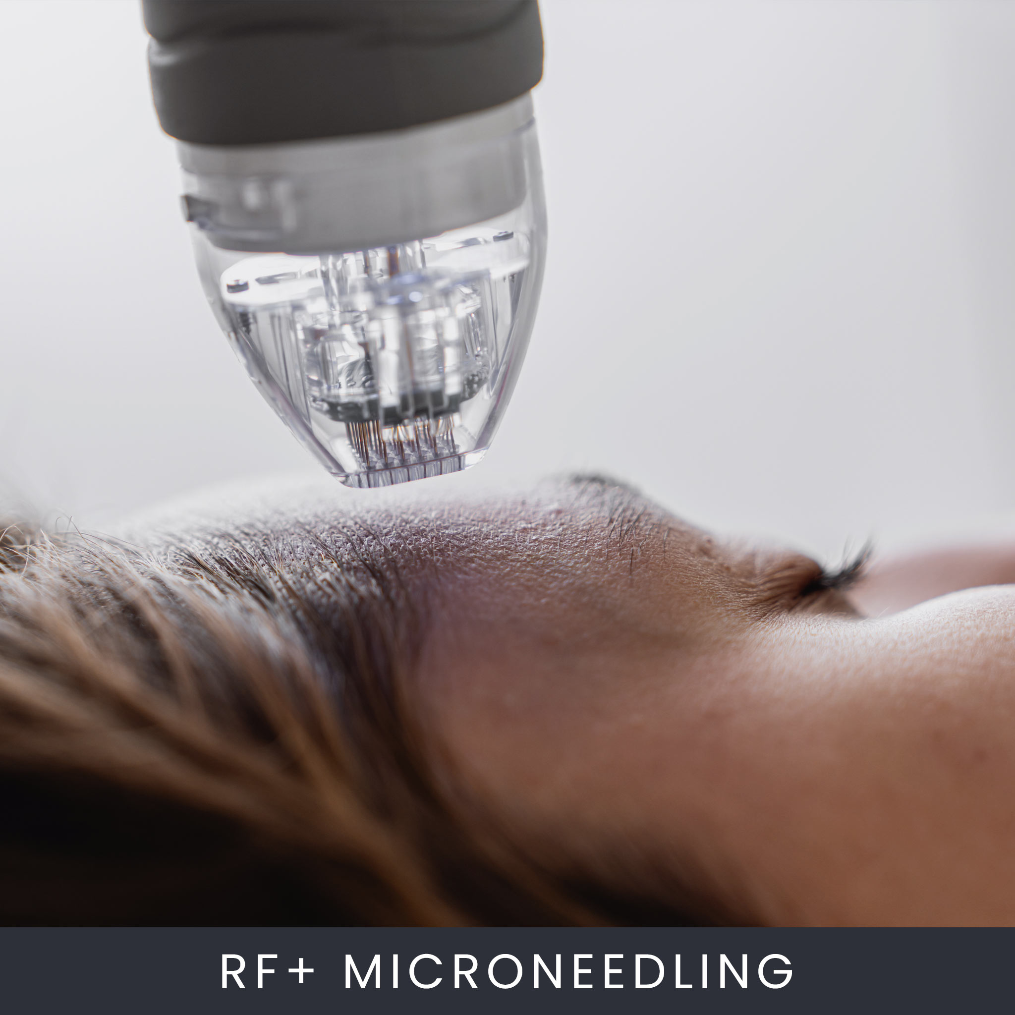 RF+ Microneedling – The Online Beauty Courses US